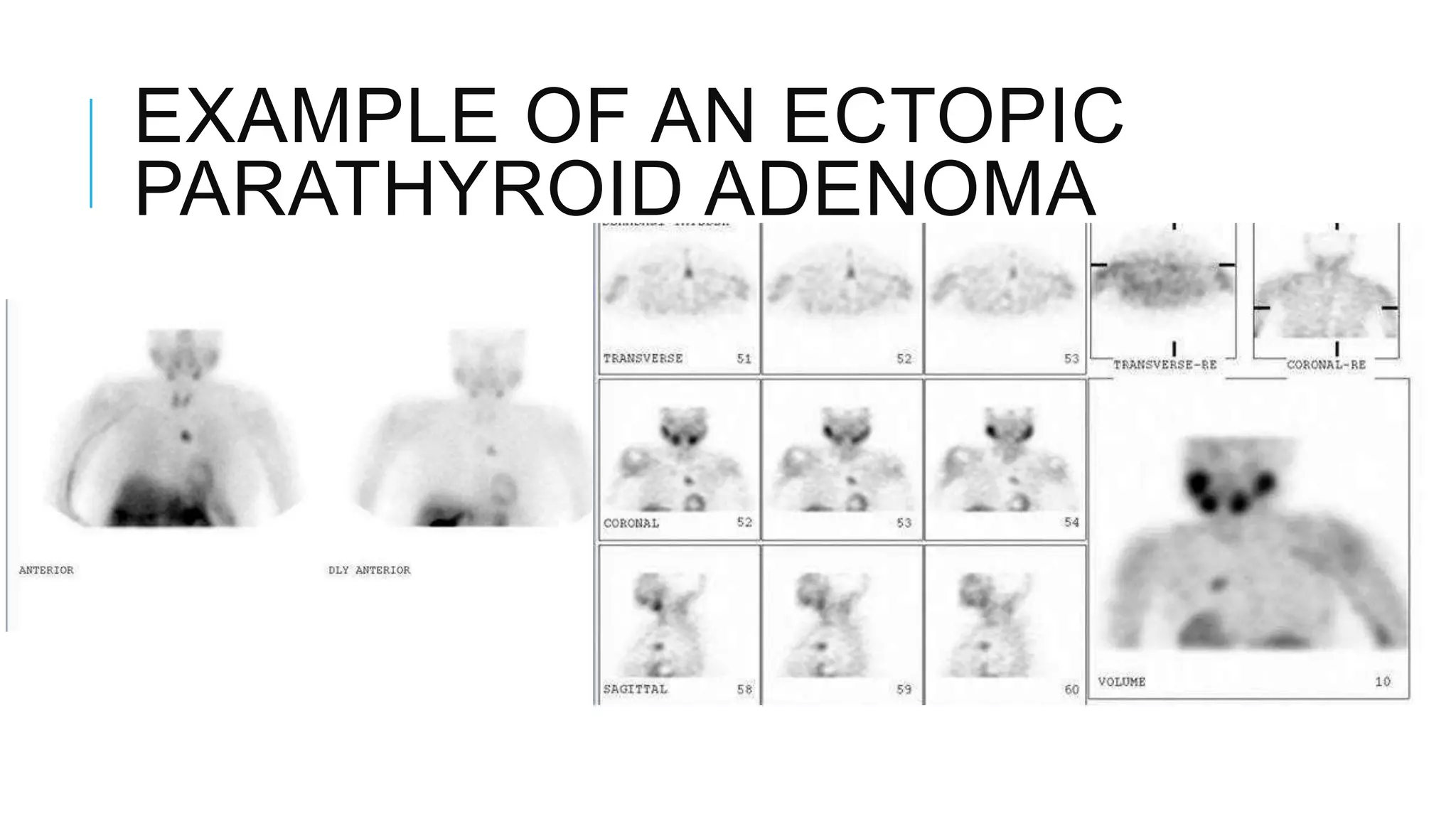 Nuclear medicine application in parathyroid diorders | PPTX