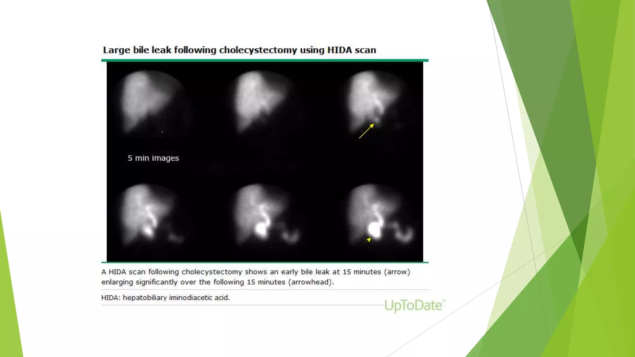 Nuclear medicine in biliary tract disorders | PPTX