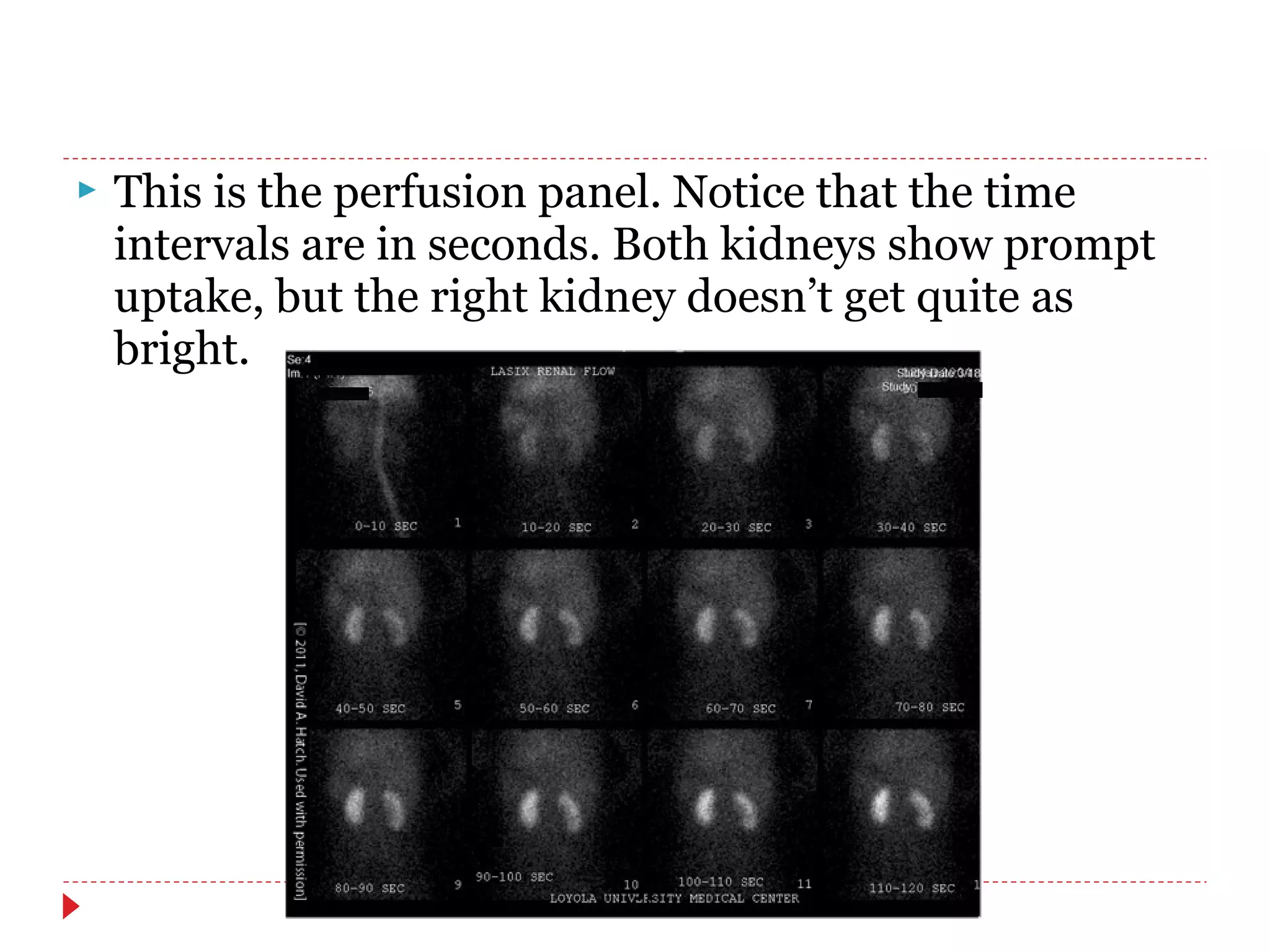 Nuclear renography | PPT