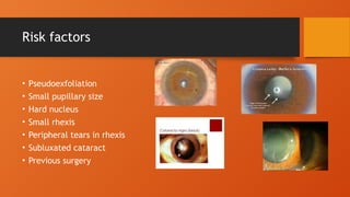 Complications of cataract surgery - nucleus drop | PPTX