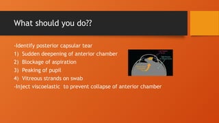 Complications of cataract surgery - nucleus drop | PPTX