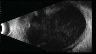 NUCLEUS DROP MIMICKING ENDOPH_ akki.pptx