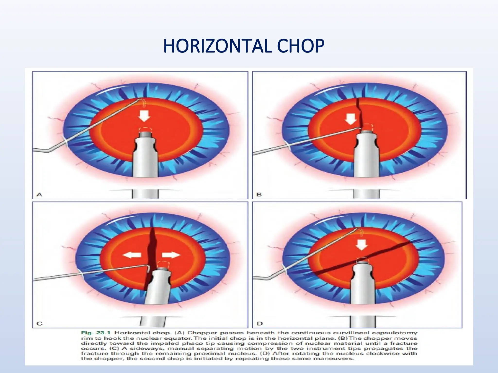 Nucleus management during phaco surgery.ppt