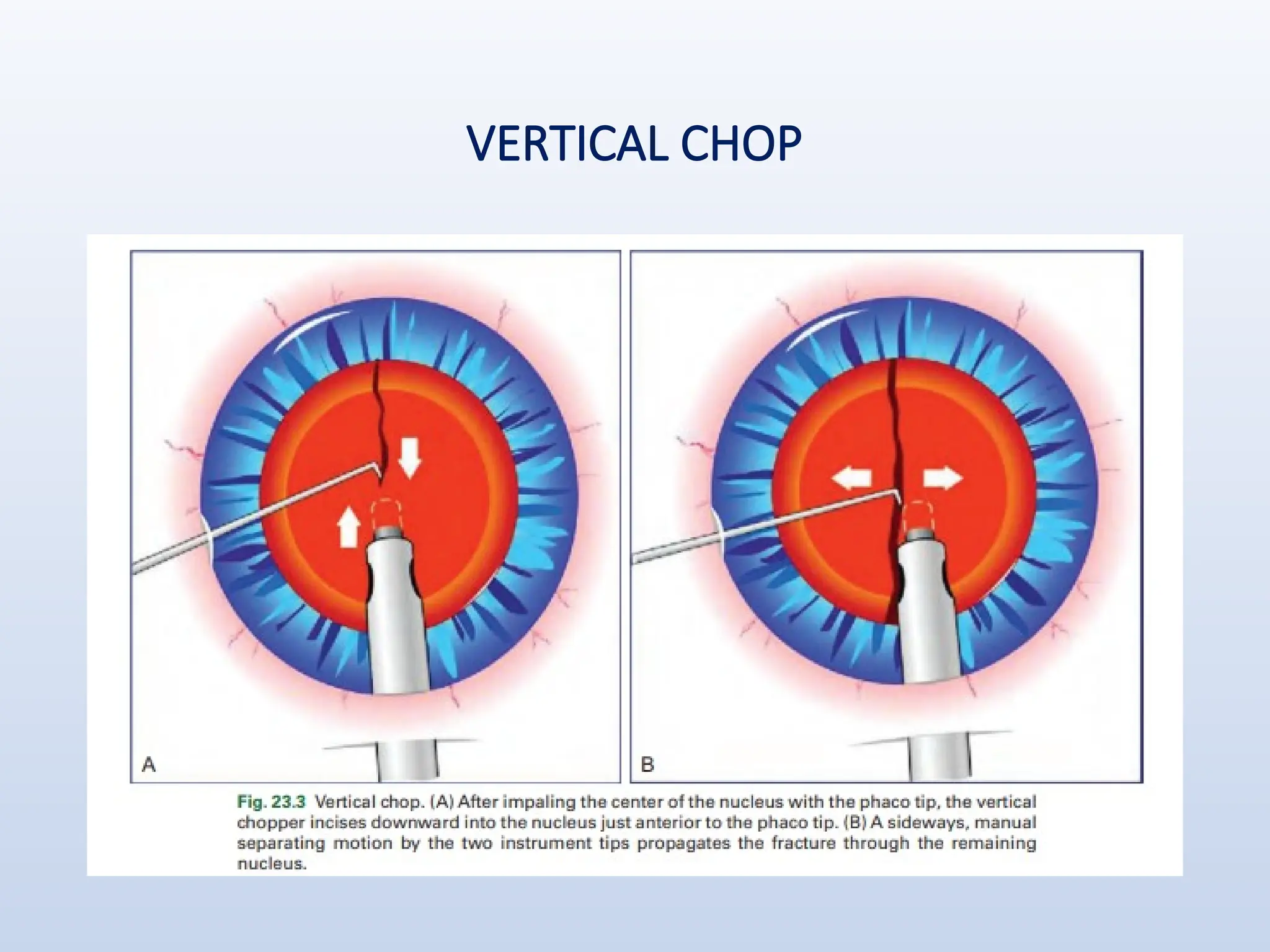 Nucleus management during phaco surgery.ppt