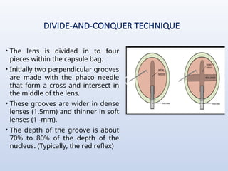 Nucleus management during phaco surgery.ppt
