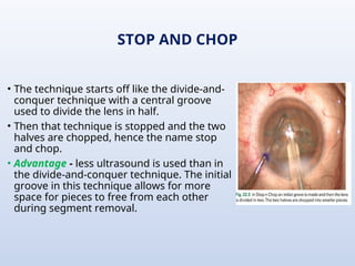 Nucleus management during phaco surgery.ppt