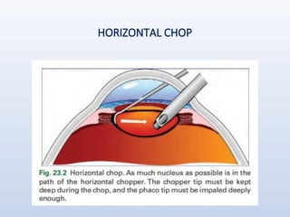 Nucleus management during phaco surgery.ppt