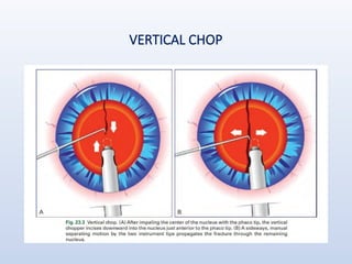 Nucleus management during phaco surgery.ppt