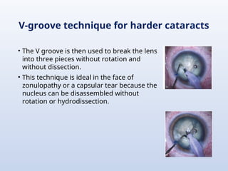 Nucleus management during phaco surgery.ppt