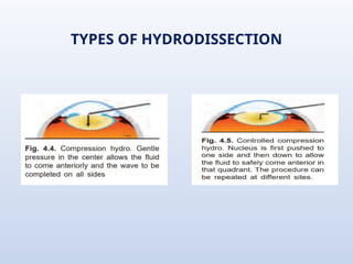 Nucleus management during phaco surgery.ppt