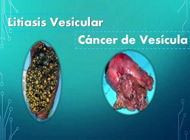 LITIASIS VESICULAR - CANCER DE VESICULA