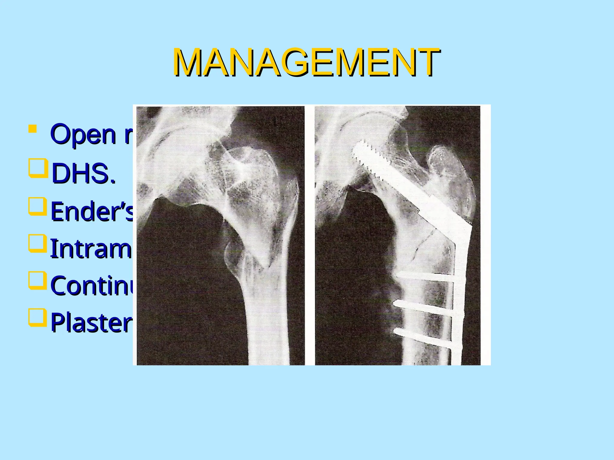 fracture neck of femur and trochanteric fracture | PPT