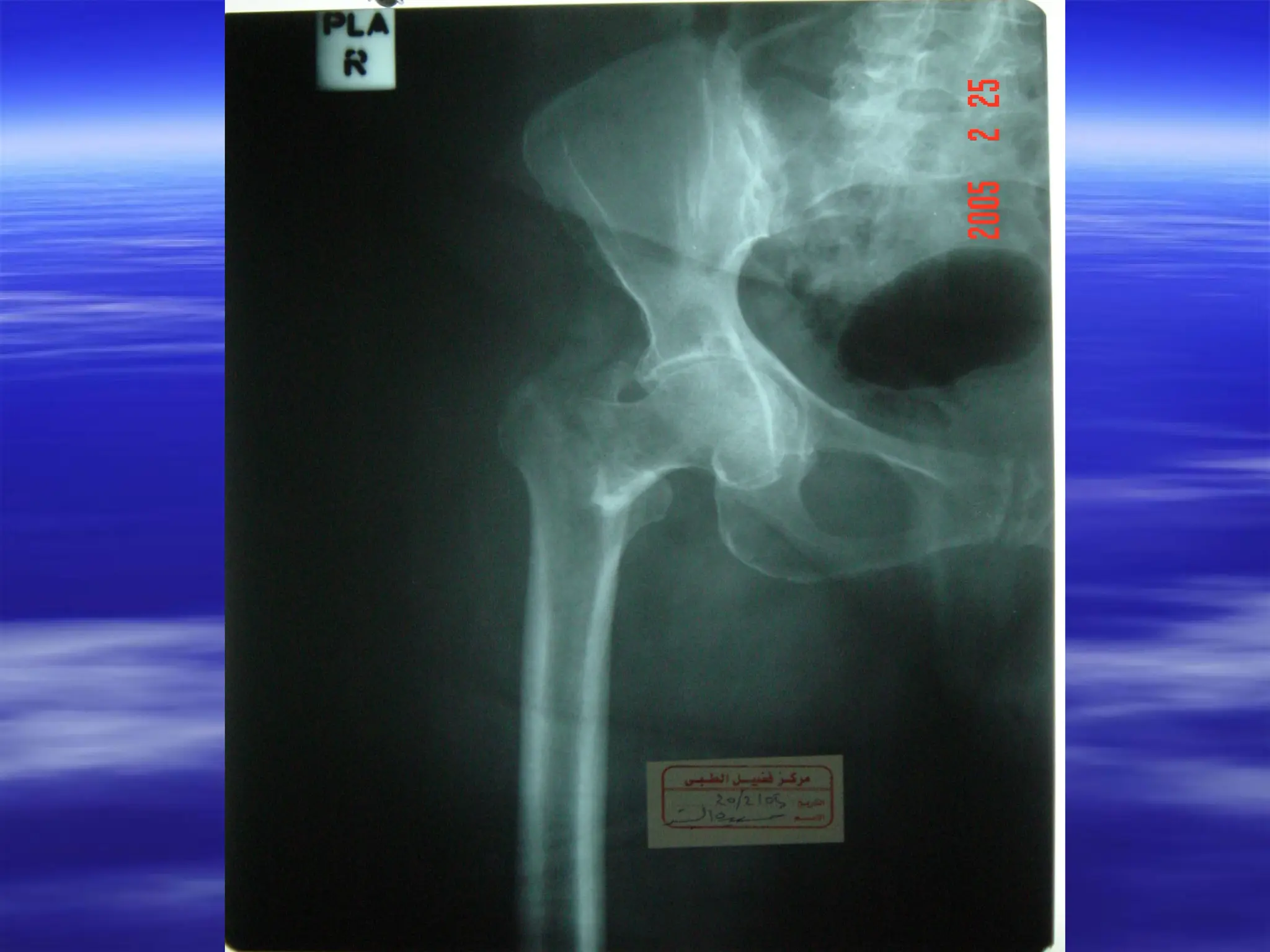 fracture neck of femur and trochanteric fracture | PPT