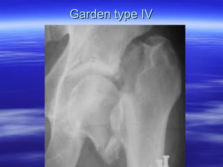 fracture neck of femur and trochanteric fracture | PPT