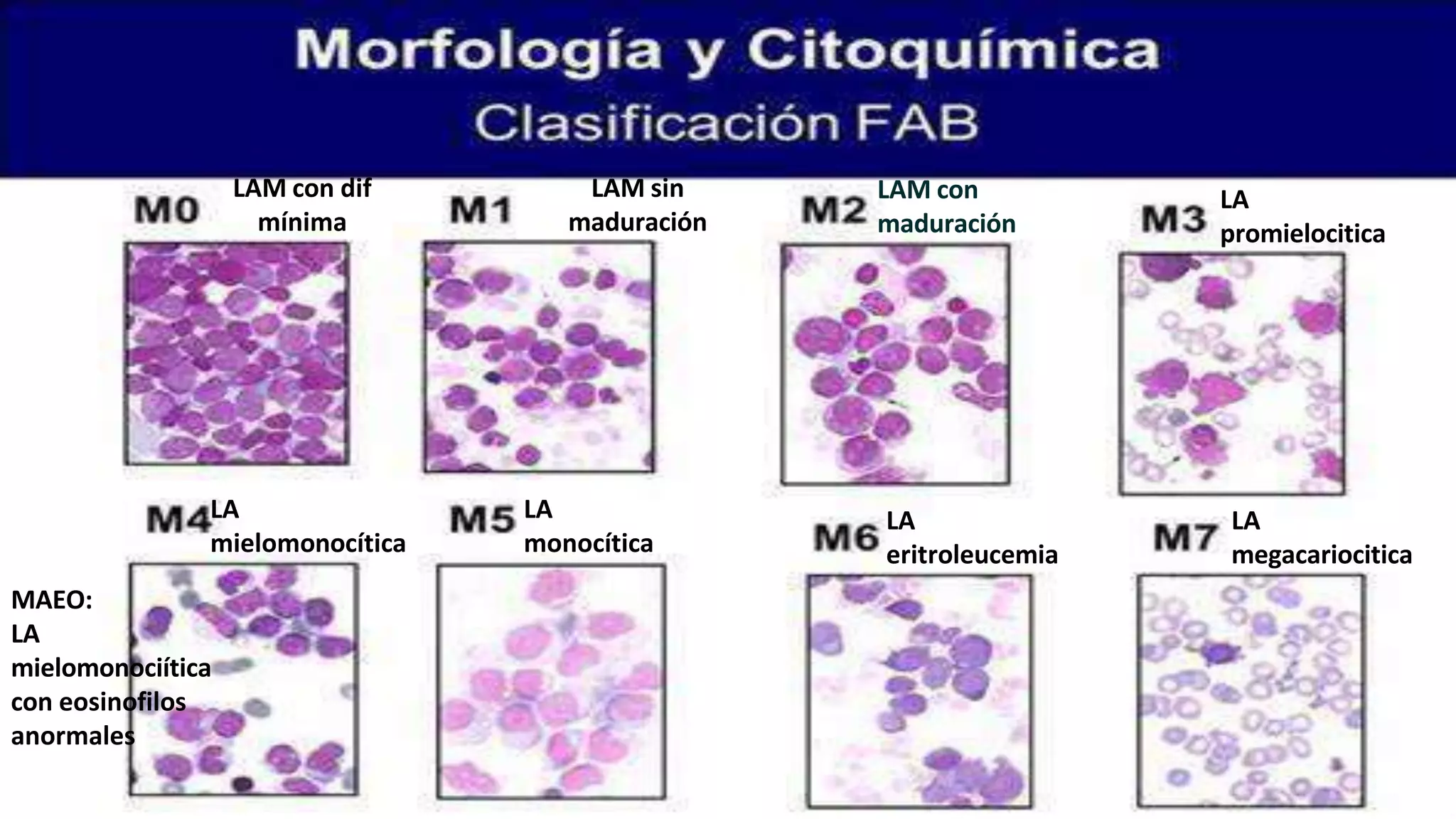 Leucemia Mieloide aguda.pptx