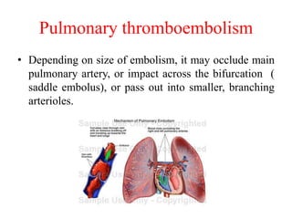 Type of thrombosis | PPTX