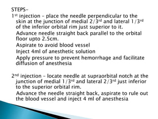 regional and topical ocular anaesthesia in ophthalmology | PPT