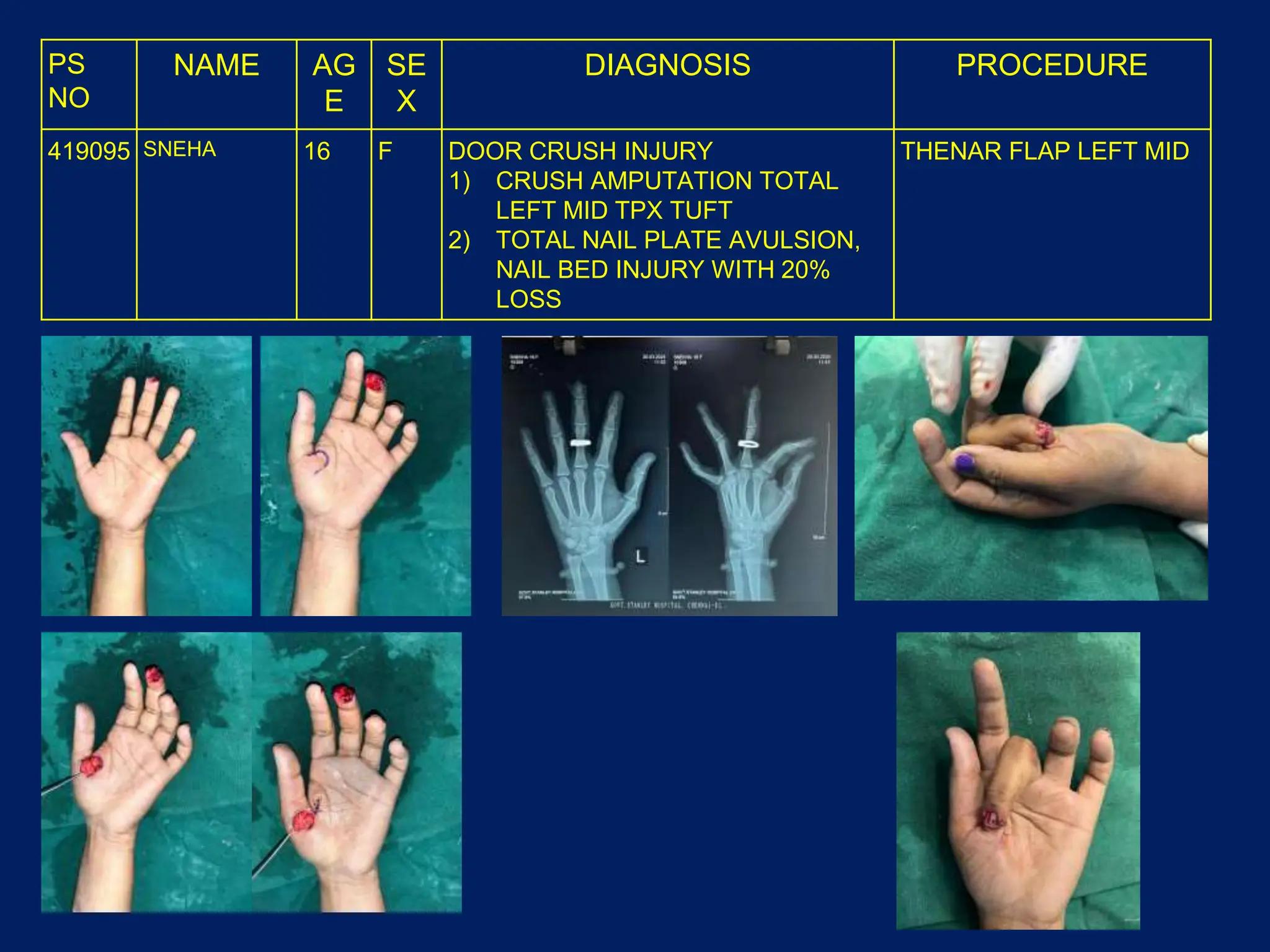 Hand injury treated in different ways.pptx
