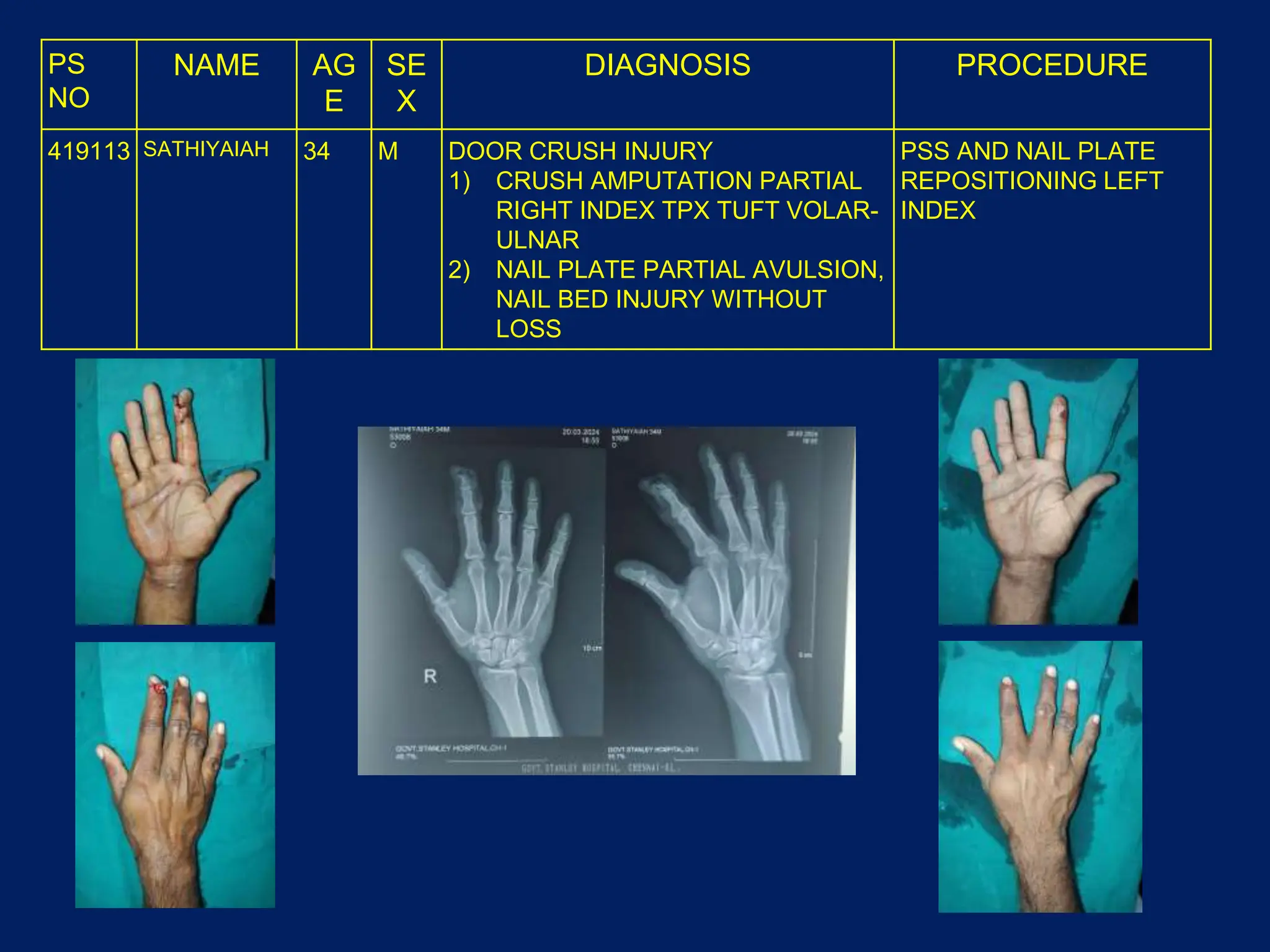 Hand injury treated in different ways.pptx