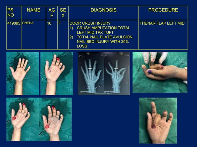 Hand injury treated in different ways.pptx