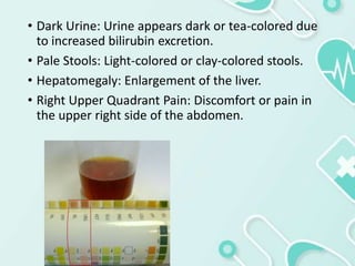 Clinical Manifestations Of Acute Viral Hepatitis | PPTX