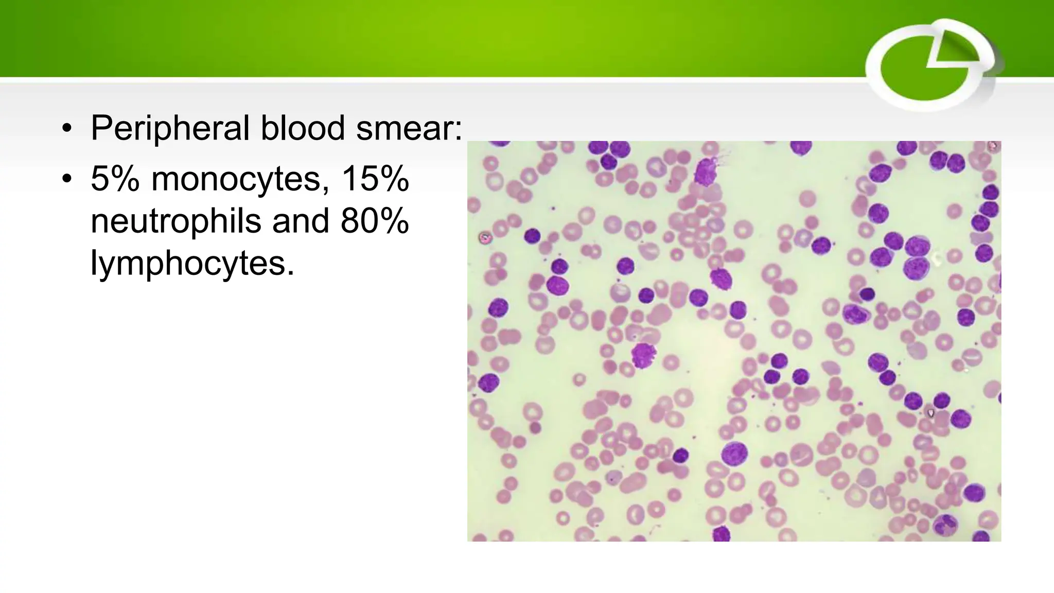 Chronic Lymphocytic Leukemia: case study | PPTX