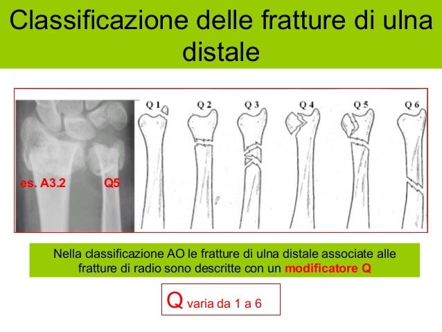 Le fratture di ulna distale associate alle fratture di radio