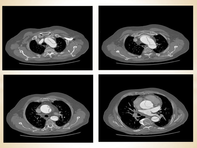 Angio Ct Aorta Abdominal Thoracic with aortic dissection,executed by ...