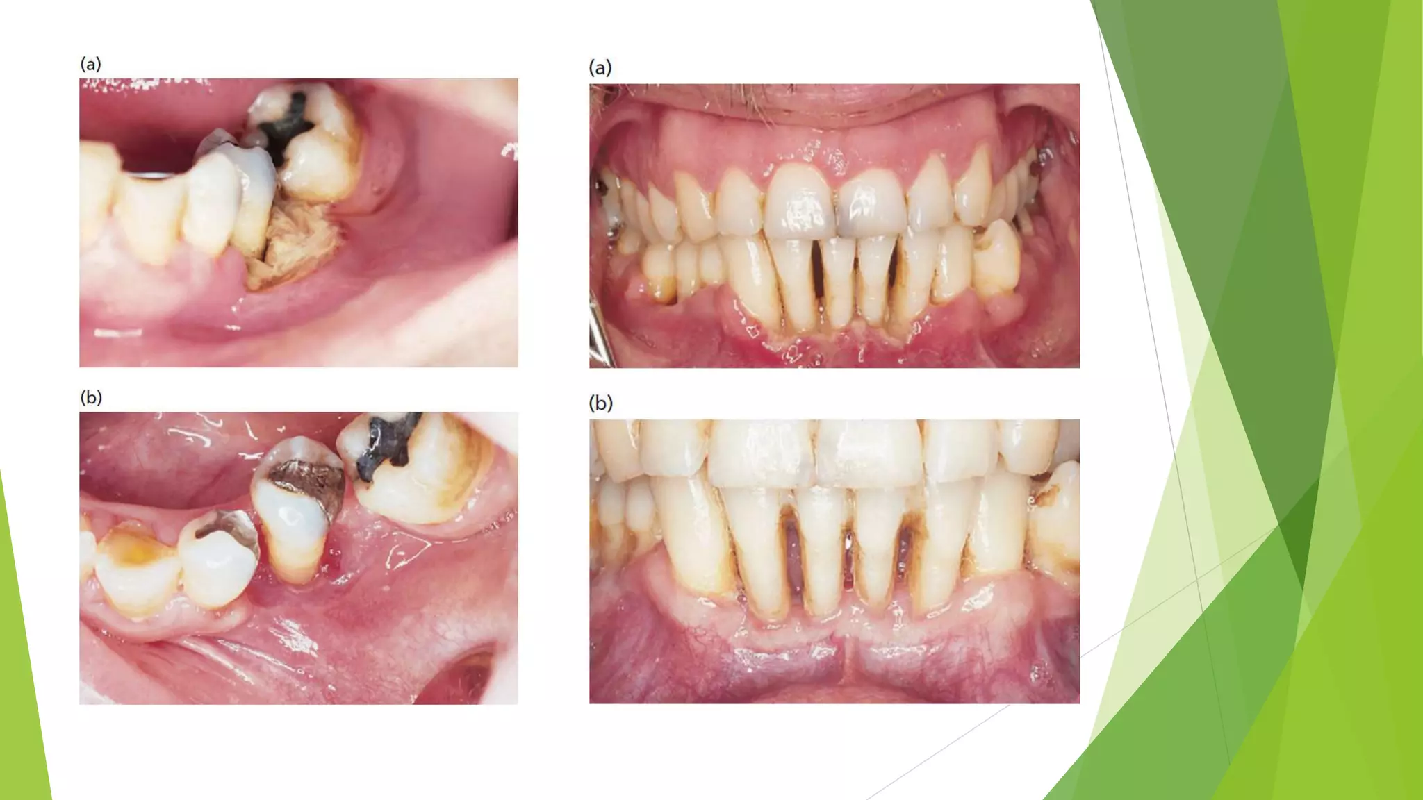 Necrotizing periodontal disease | PPTX