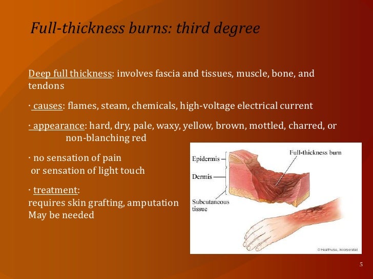 Nurs202 burn injuries final