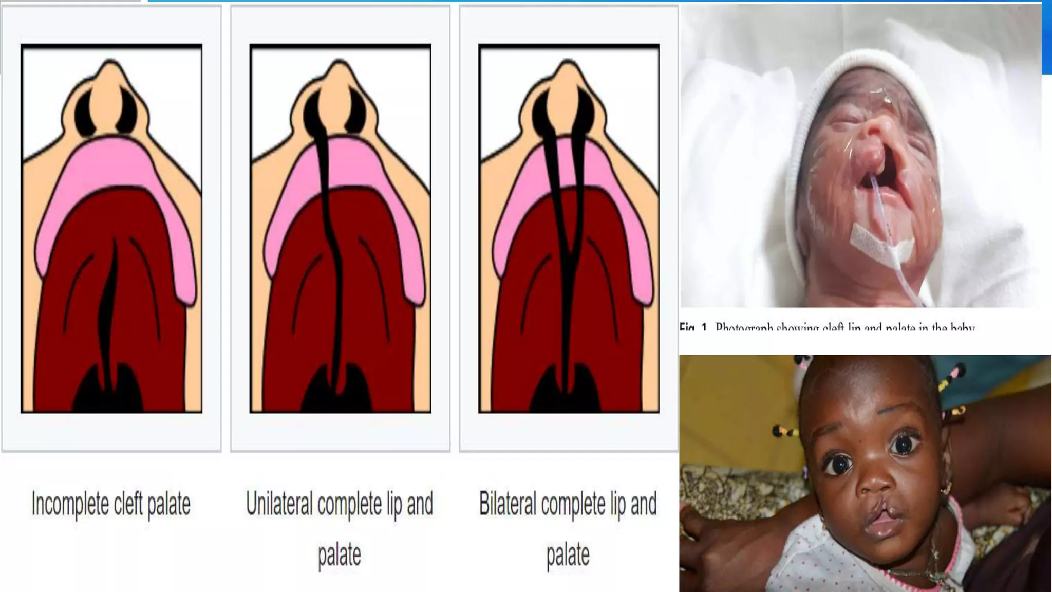 Omphalocele/Exomphalos, cleft palate & Oesophageal atresia and Nursing ...