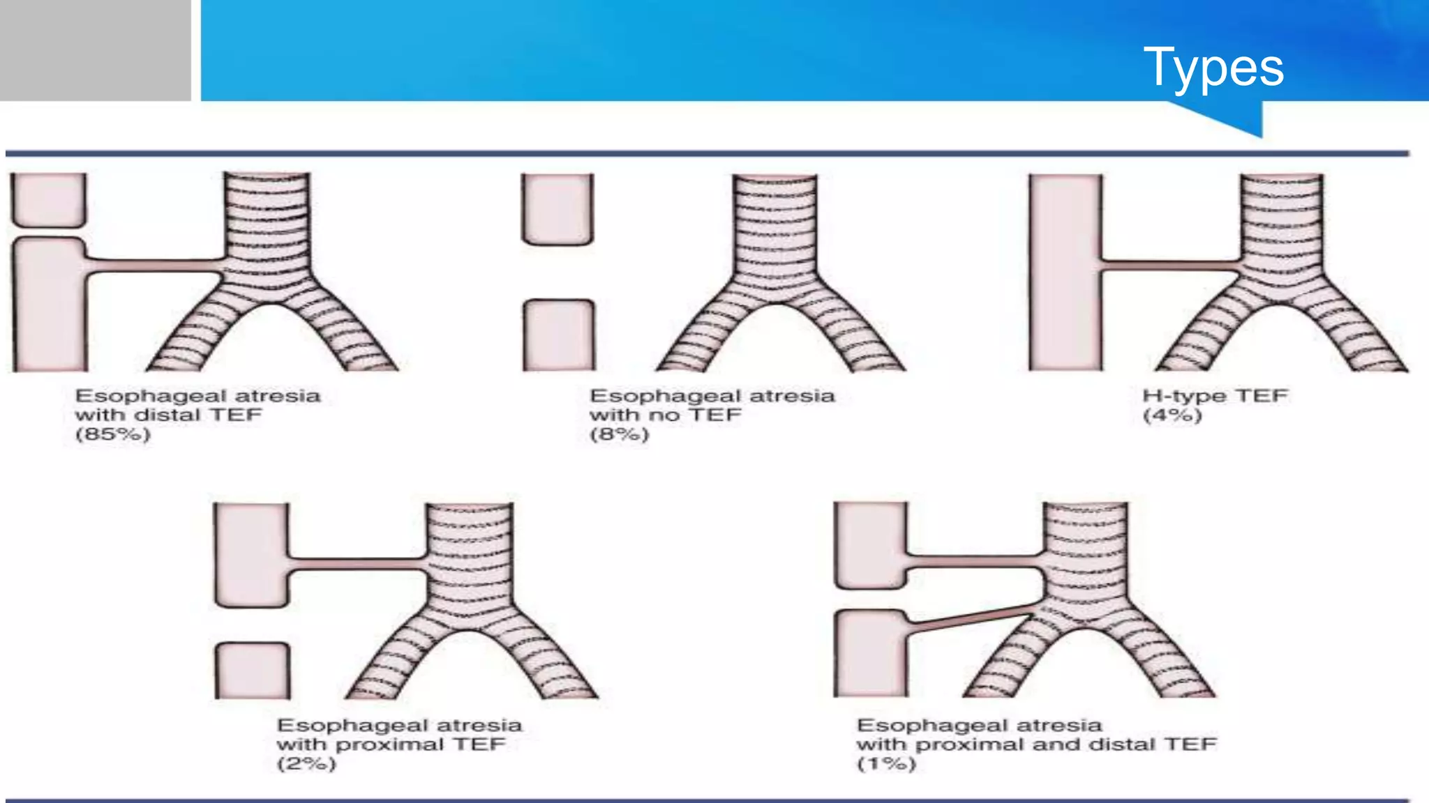 Omphalocele/Exomphalos, cleft palate & Oesophageal atresia and Nursing ...