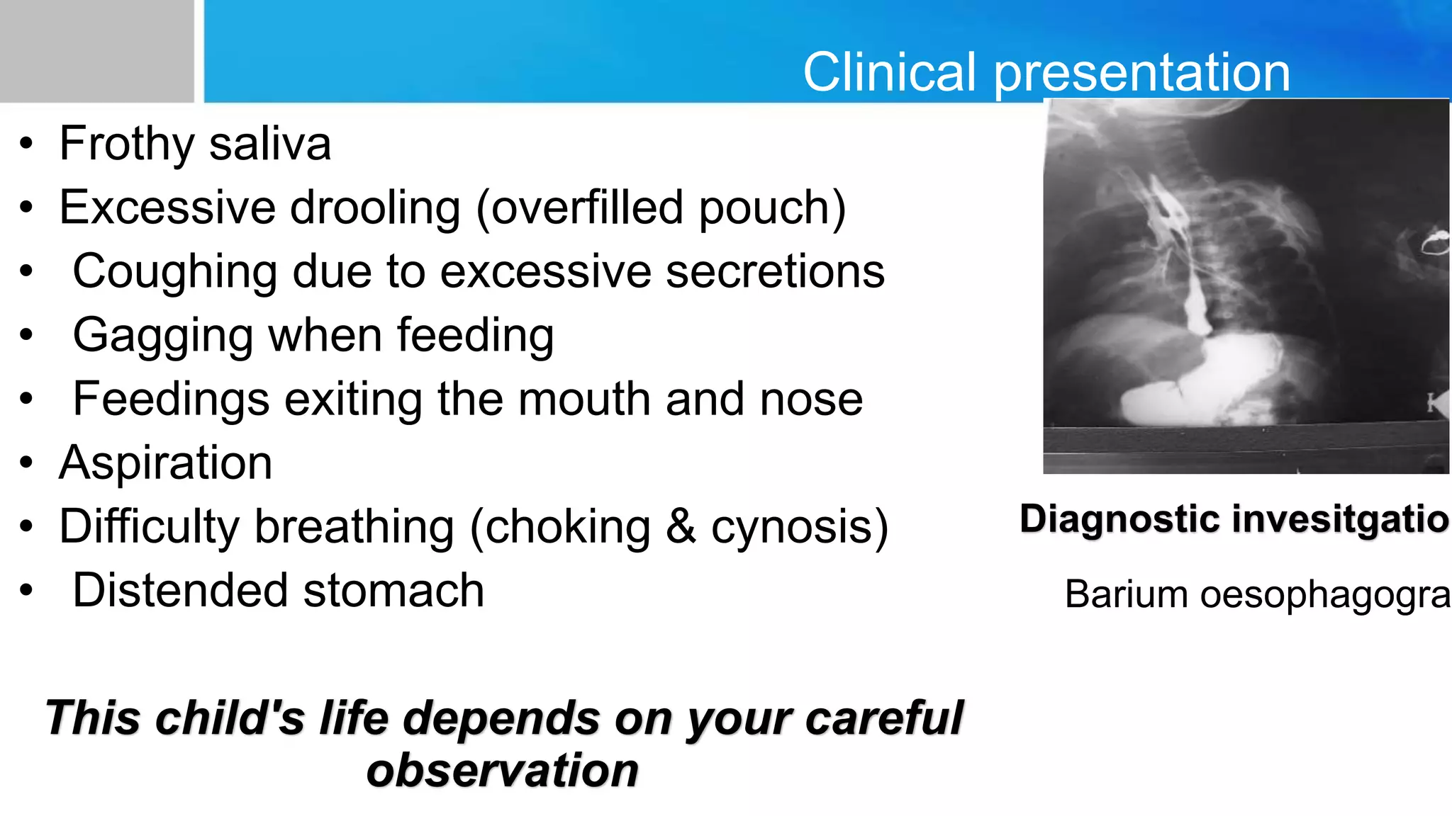 Omphalocele/Exomphalos, cleft palate & Oesophageal atresia and Nursing ...