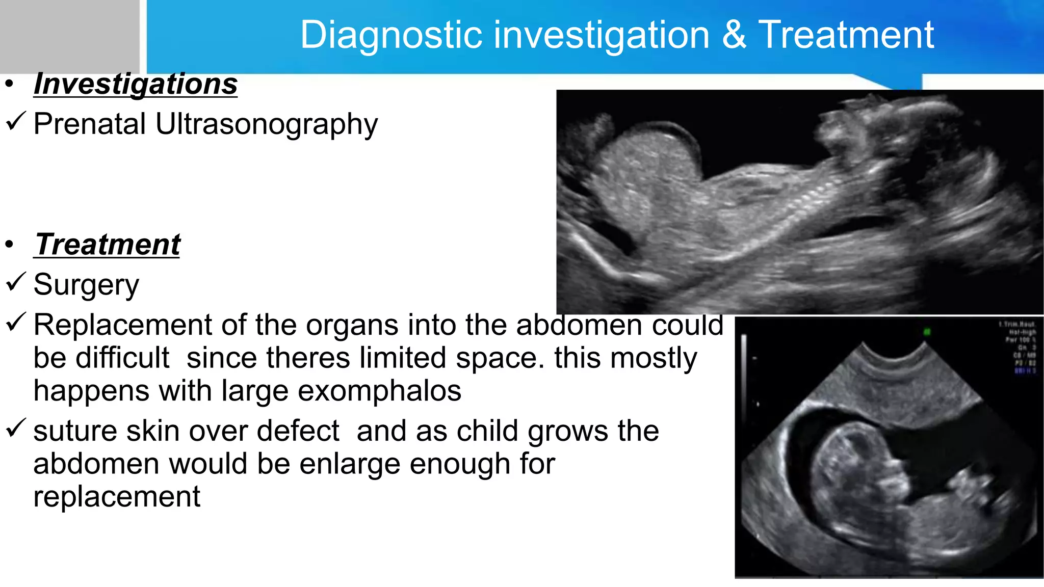Omphalocele/Exomphalos, cleft palate & Oesophageal atresia and Nursing ...