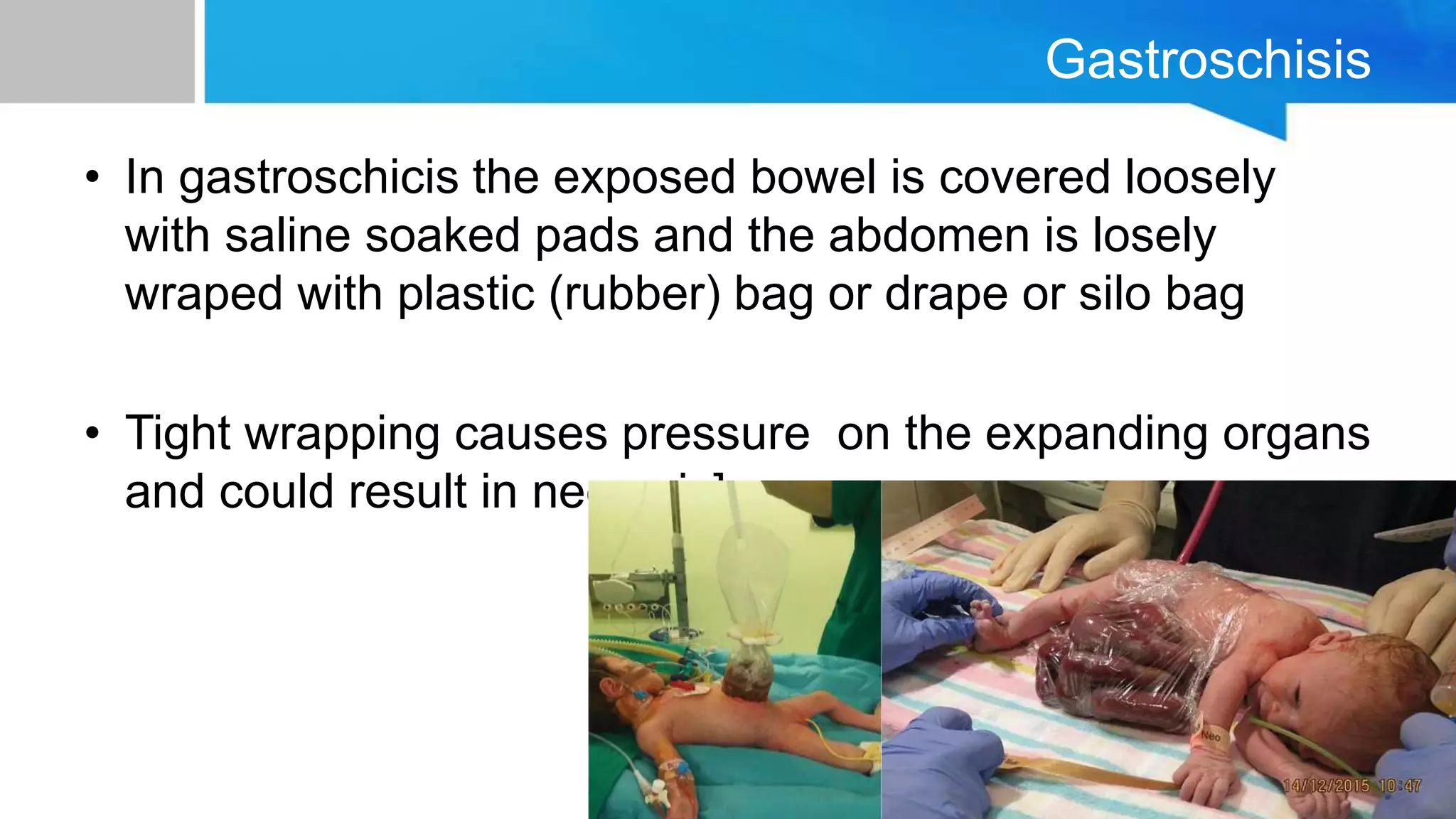 Omphalocele/Exomphalos, cleft palate & Oesophageal atresia and Nursing ...