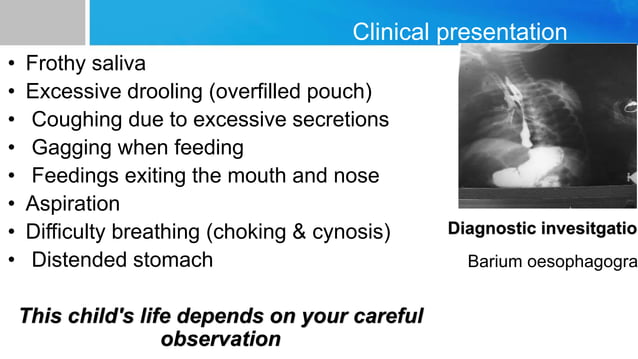 Omphalocele/Exomphalos, cleft palate & Oesophageal atresia and Nursing ...