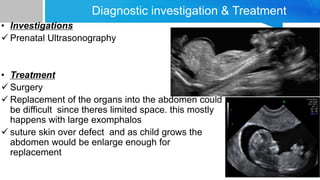 Omphalocele/Exomphalos, cleft palate & Oesophageal atresia and Nursing ...