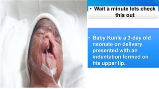 Omphalocele/Exomphalos, cleft palate & Oesophageal atresia and Nursing ...