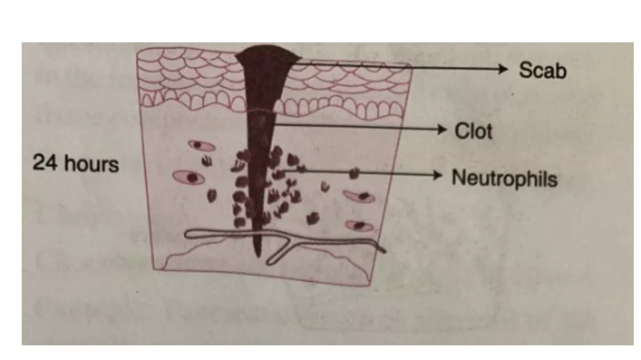 Chronic inflammation, Wound healing - Pathology - Nursing | PDF