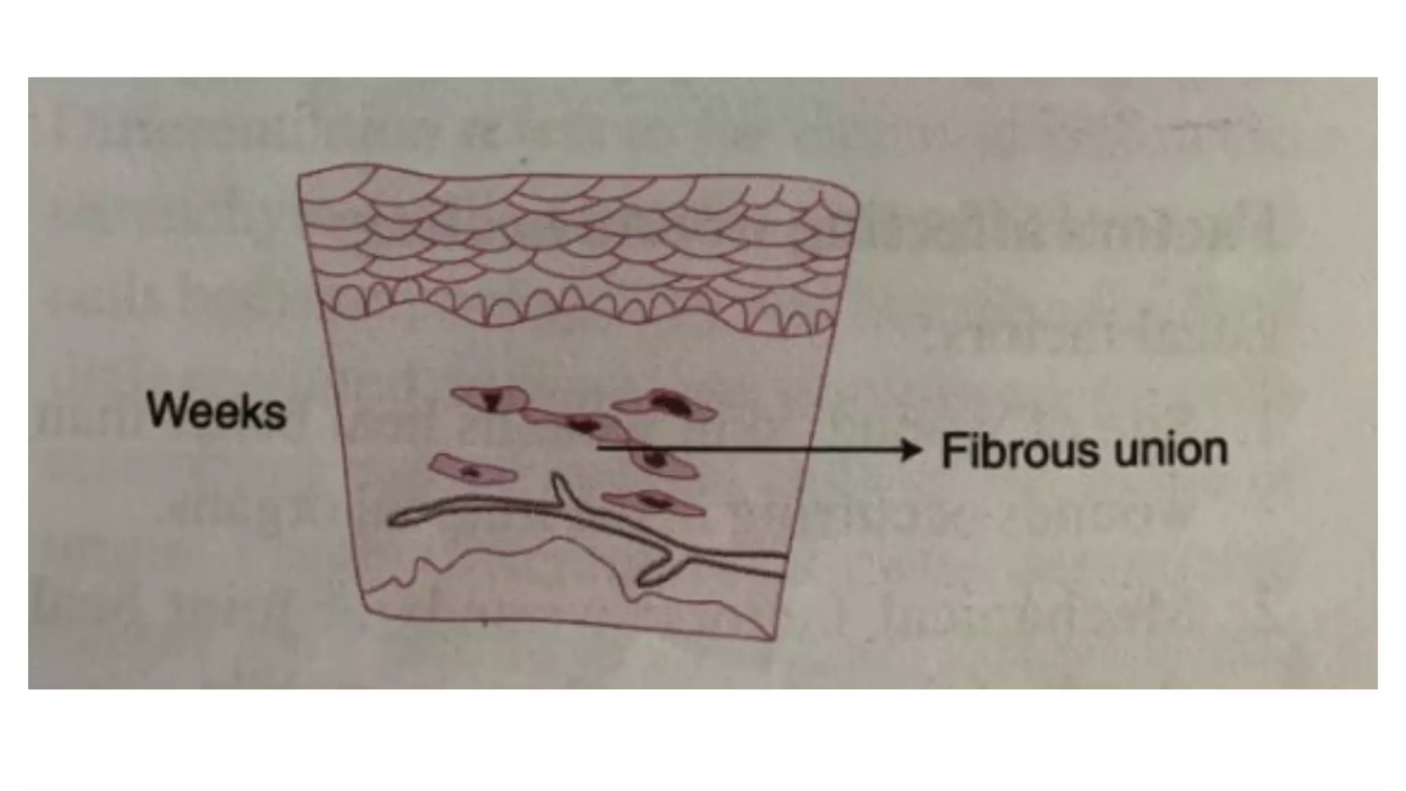 Chronic inflammation, Wound healing - Pathology - Nursing | PDF