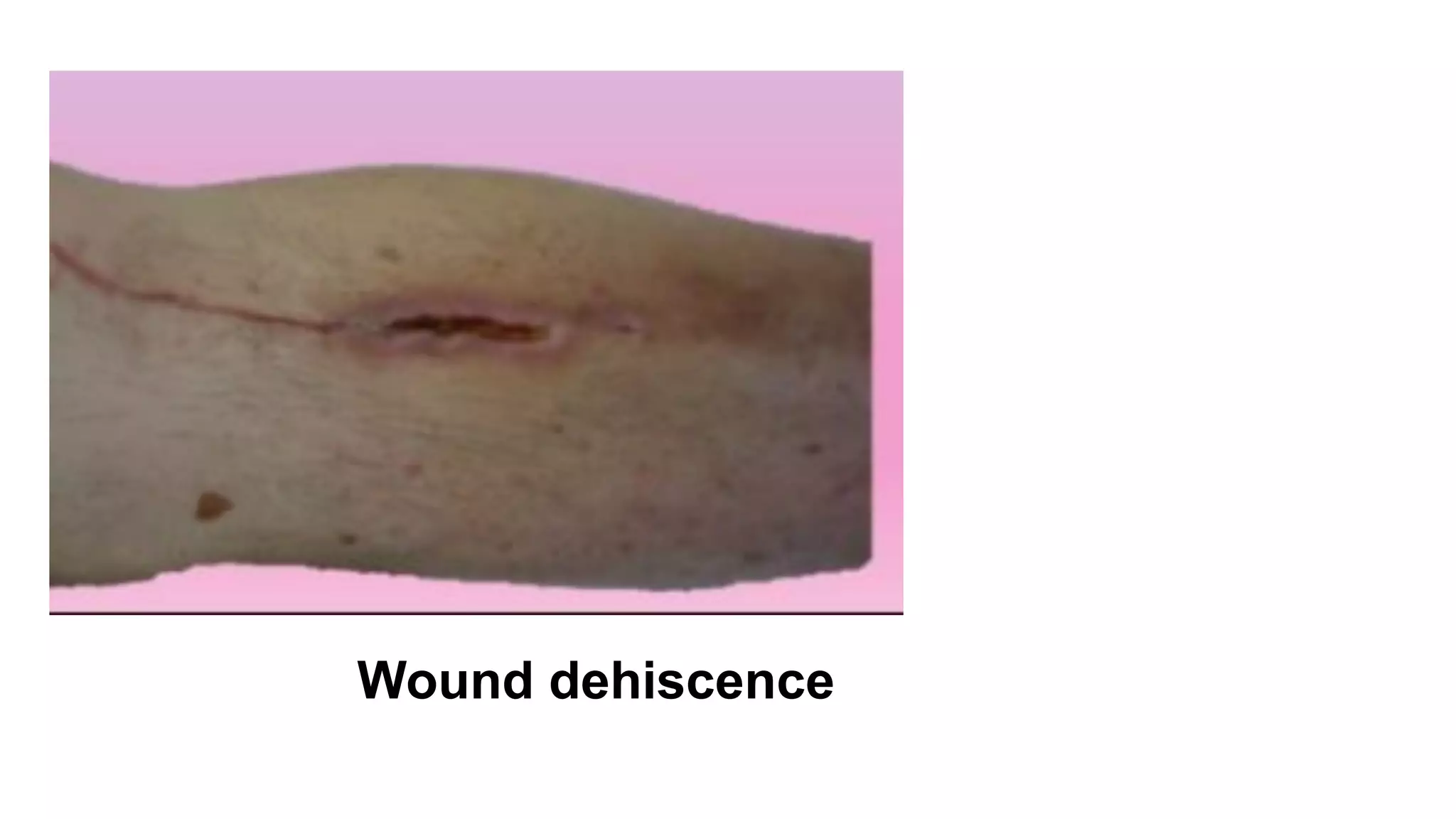 Chronic inflammation, Wound healing - Pathology - Nursing | PDF