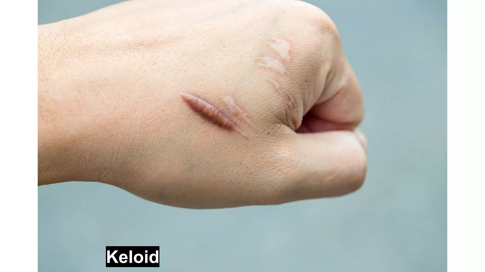 Chronic inflammation, Wound healing - Pathology - Nursing | PDF