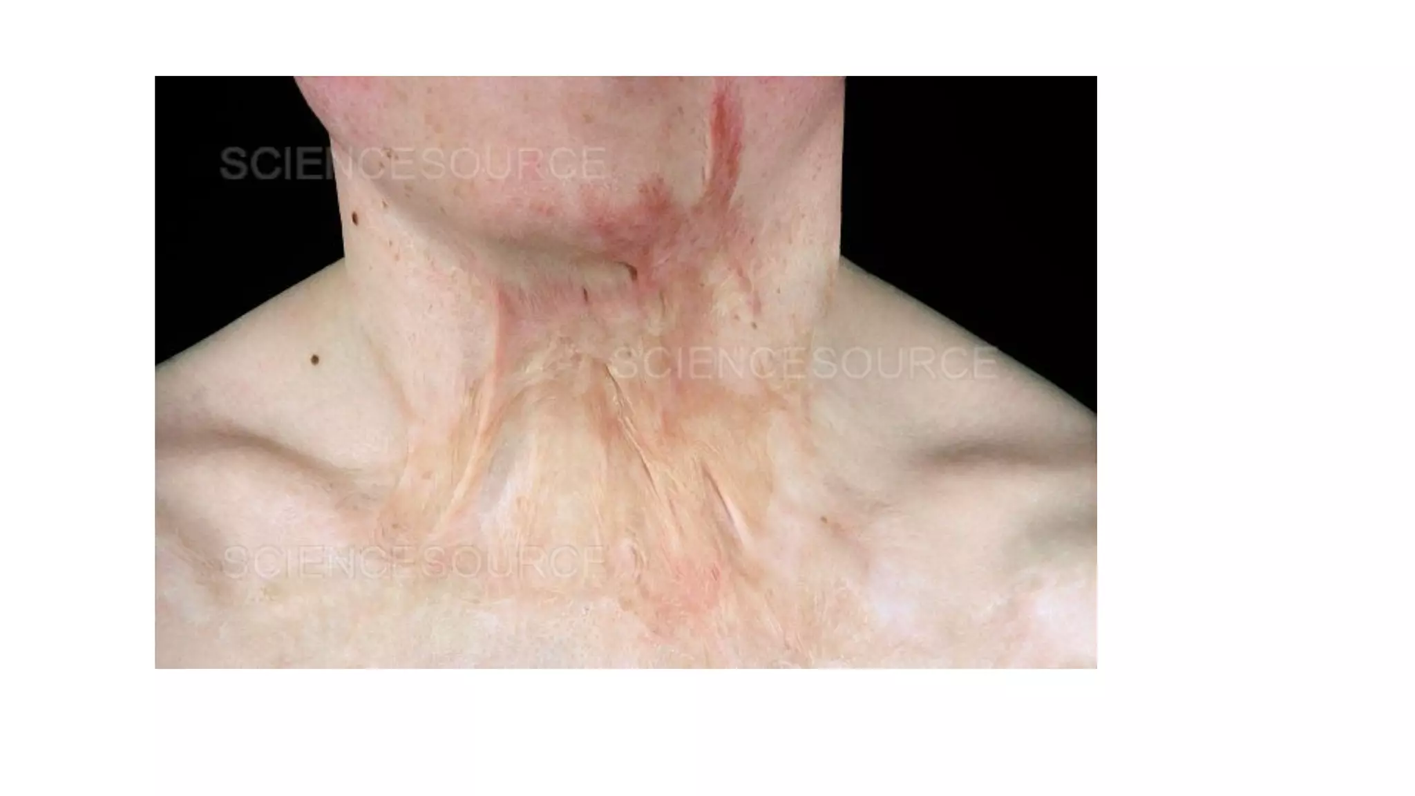 Chronic inflammation, Wound healing - Pathology - Nursing | PDF