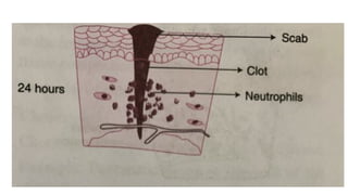 Chronic inflammation, Wound healing - Pathology - Nursing | PDF