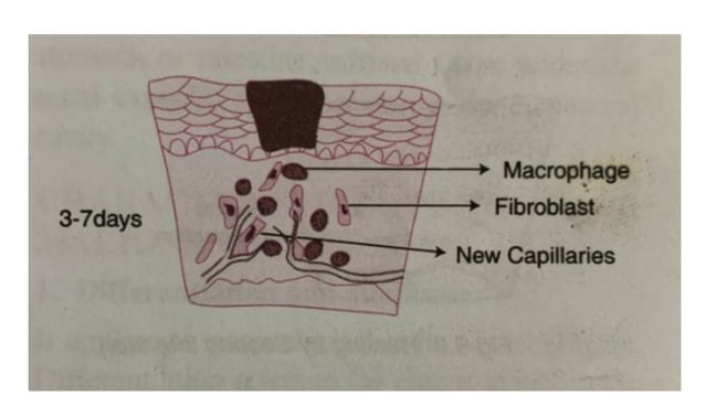 Chronic inflammation, Wound healing - Pathology - Nursing | PDF