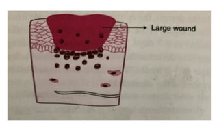 Chronic inflammation, Wound healing - Pathology - Nursing | PDF