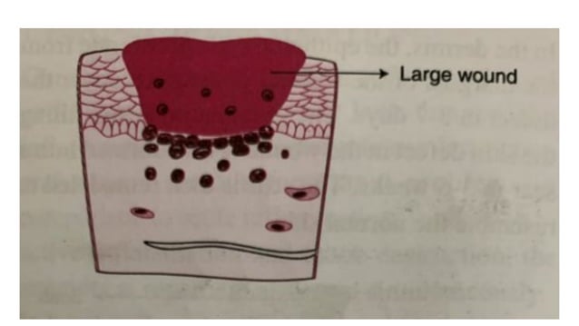 Chronic inflammation, Wound healing - Pathology - Nursing | PDF