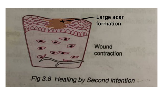 Chronic inflammation, Wound healing - Pathology - Nursing | PDF