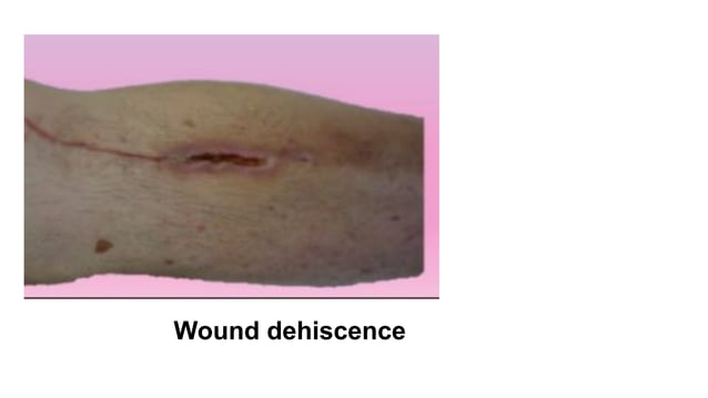 Chronic inflammation, Wound healing - Pathology - Nursing | PDF