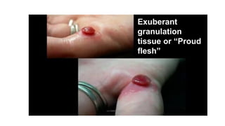 Chronic inflammation, Wound healing - Pathology - Nursing | PDF